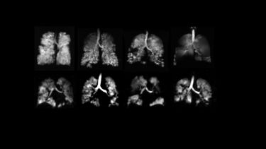 Pioneering detailed lung MRI scans without radiation | Research | The ...