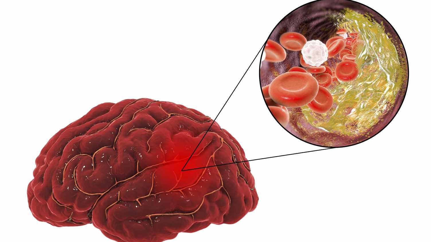Heart disease causes early brain dysfunction and can treble key ...